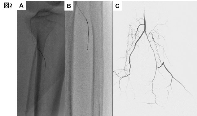 Cordis | “とりあえず”から最後までとことん使える。 新たな0.014″ GW VASSALLO® GT NS1 加藤拓先生