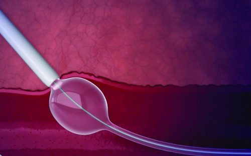 Cordis | MYNXGRIP™ Vascular Closure Device